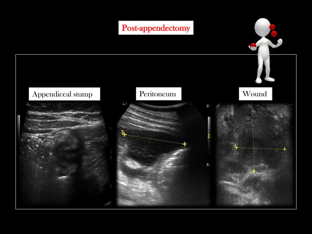 Emergency Ultrasound Course -Lecture 04 -Acute Appendicitis -Part 3 ...