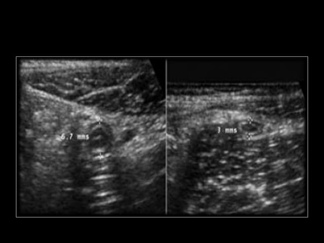 Emergency Ultrasound Course -Lecture 04 -Acute Appendicitis -Part 3 ...