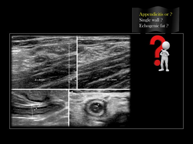 Emergency Ultrasound Course -Lecture 04 -Acute Appendicitis -Part 3 ...