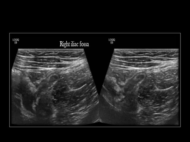 Emergency Ultrasound Course -Lecture 04 -Acute Appendicitis -Part 3 ...