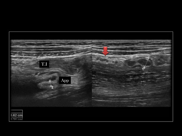 Emergency Ultrasound Course -Lecture 04 -Acute Appendicitis -Part 3 ...