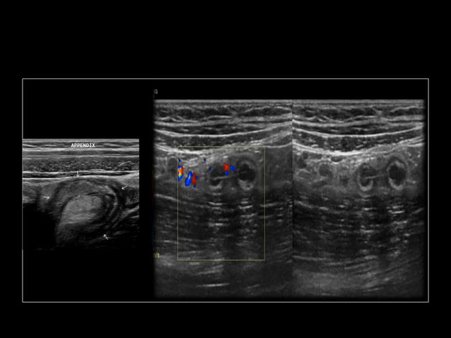 Emergency Ultrasound Course -Lecture 04 -Acute Appendicitis -Part 3 ...