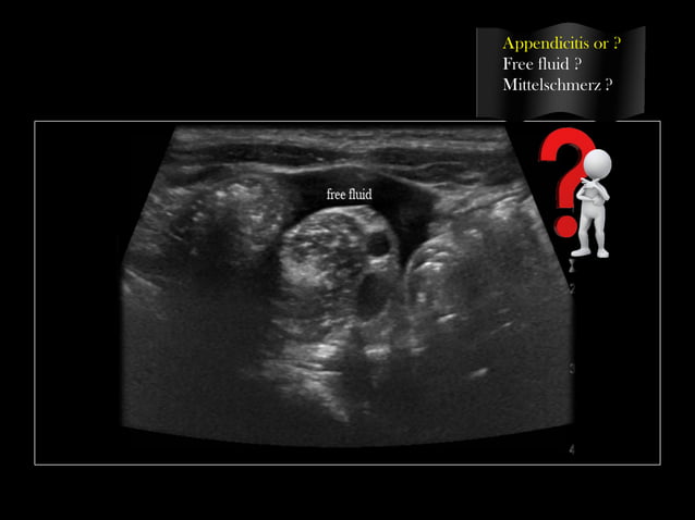 Emergency Ultrasound Course -Lecture 04 -Acute Appendicitis -Part 3 ...