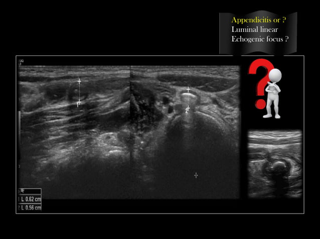 Emergency Ultrasound Course -Lecture 04 -Acute Appendicitis -Part 3 ...