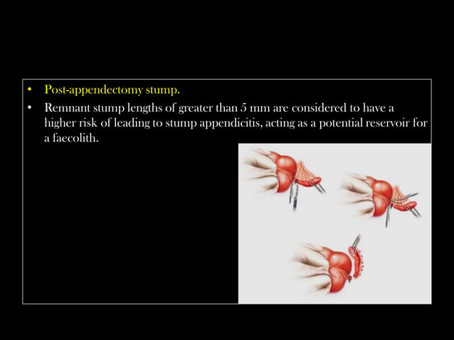 Emergency Ultrasound Course -Lecture 04 -Acute Appendicitis -Part 3 ...