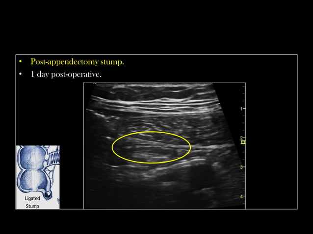 Emergency Ultrasound Course -Lecture 04 -Acute Appendicitis -Part 3 ...