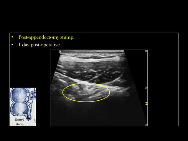 Emergency Ultrasound Course -Lecture 04 -Acute Appendicitis -Part 3 ...