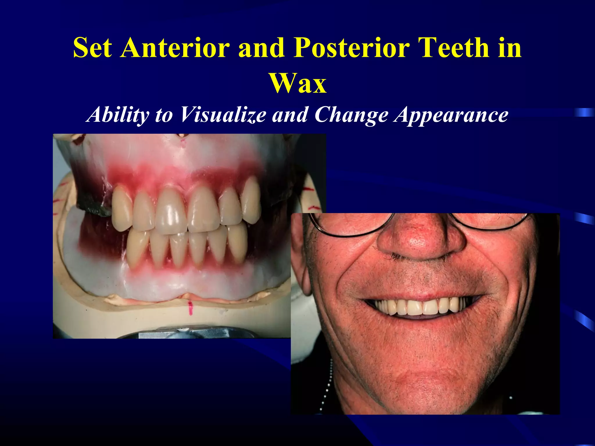 Complete denture - Introduction to Prosthodontics | PPT