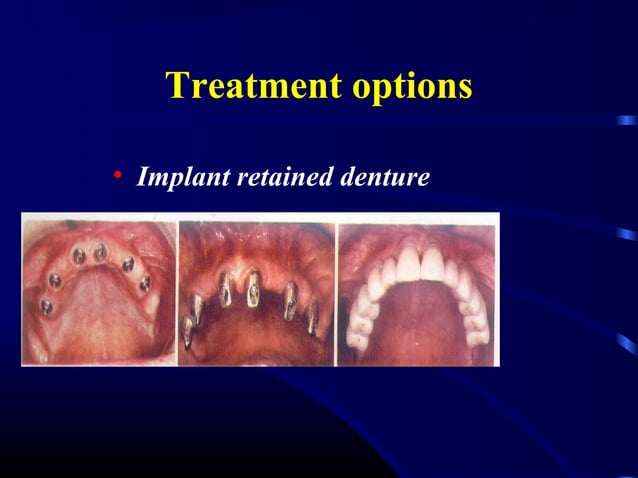 Complete denture - Introduction to Prosthodontics | PPT