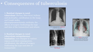 Definition of tuberculosis as scientific and practical problem | PPT