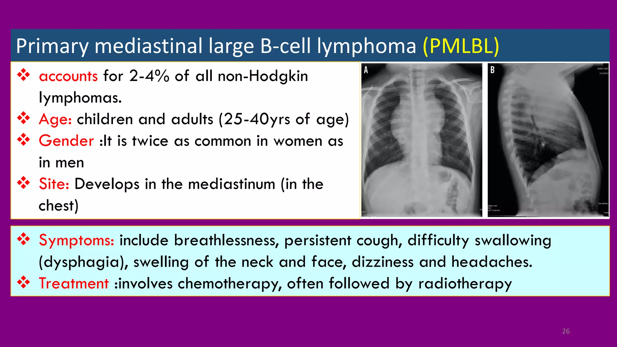 Pediatric Non Hodgkin lymphoma NEW.pdf