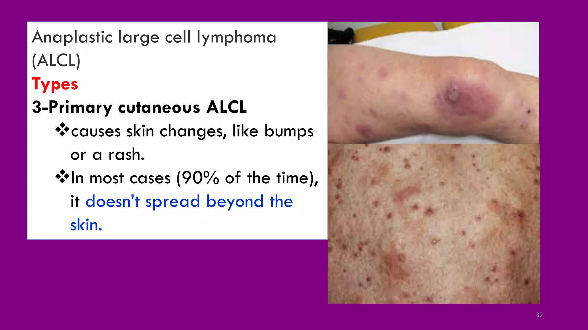 Pediatric Non Hodgkin lymphoma NEW.pdf