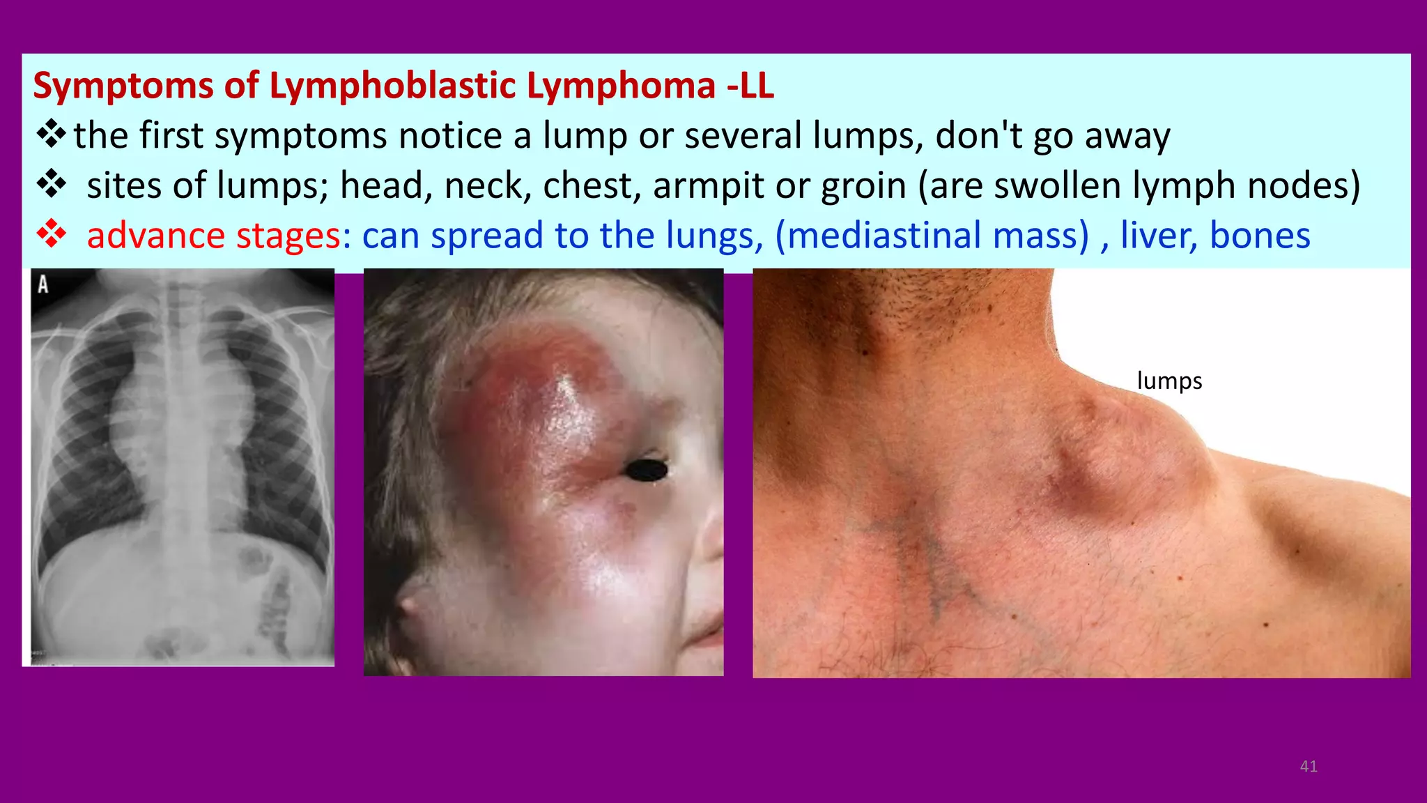 Pediatric Non Hodgkin lymphoma NEW.pdf