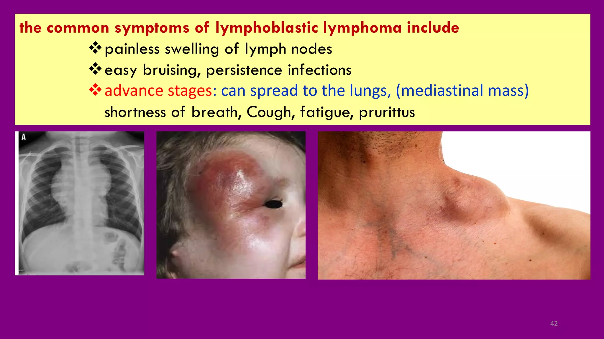 Pediatric Non Hodgkin lymphoma NEW.pdf
