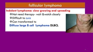 Pediatric Non Hodgkin lymphoma NEW.pdf