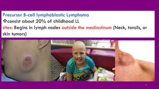 Pediatric Non Hodgkin lymphoma NEW.pdf