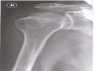 Lecture 10 shoulder rehab | PPT
