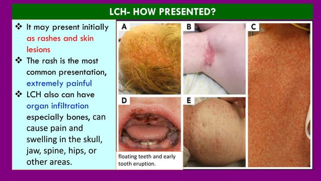 Langerhans Cell Histiocytosis (LCH).pdf | Blood Disorders | Diseases and Conditions