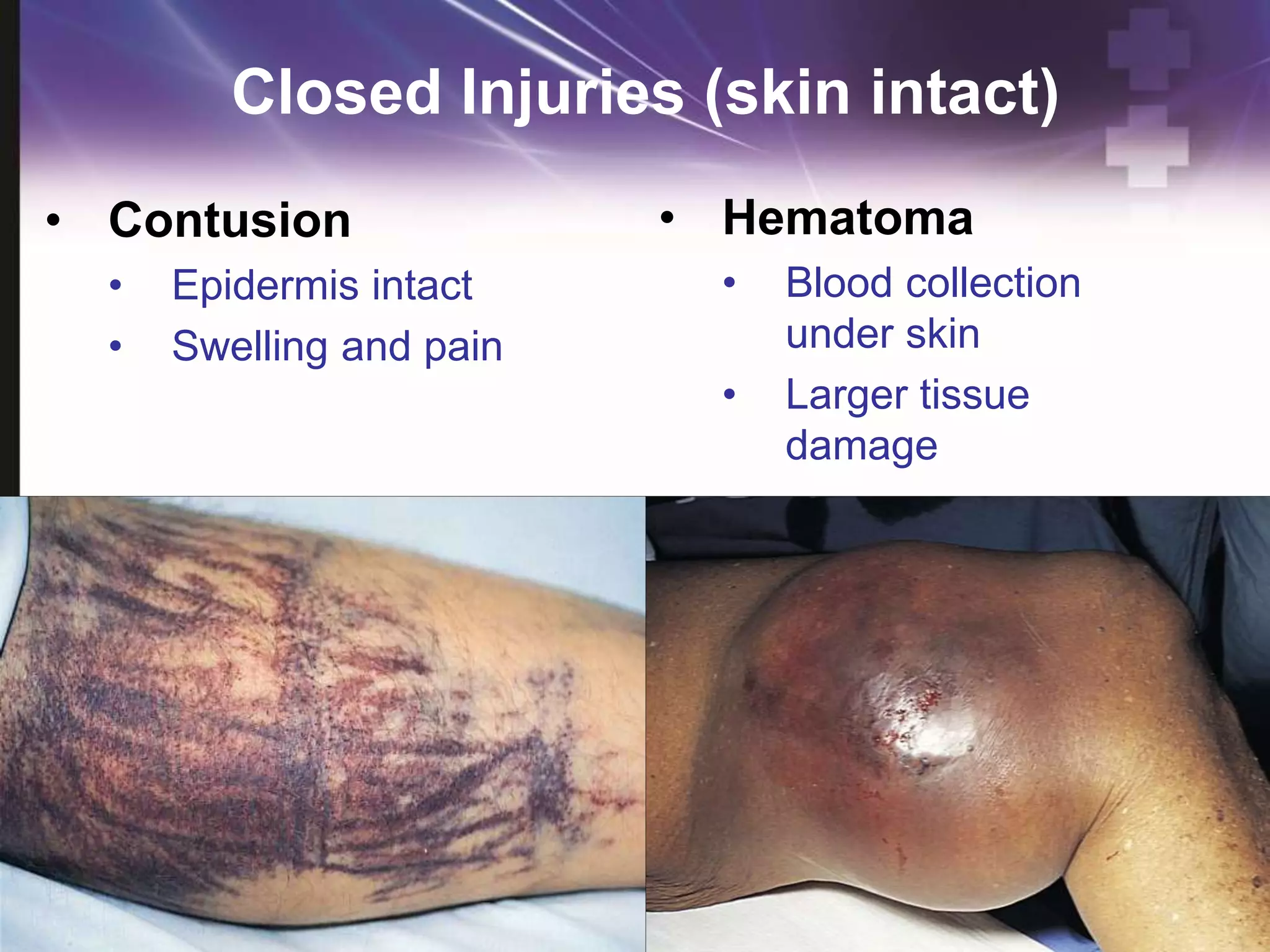 Lecture 11-Soft tissue injuries-1.pptx