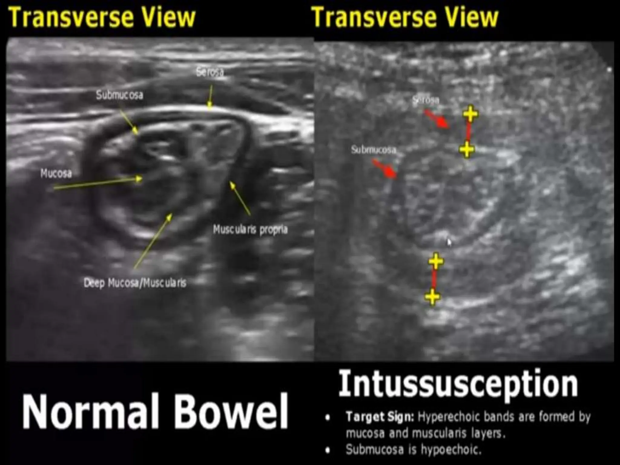 lecture 11 Gastric and small bowel US.pptx