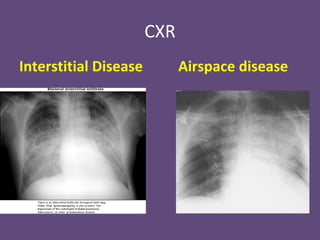 interstitial lung disease | PPT