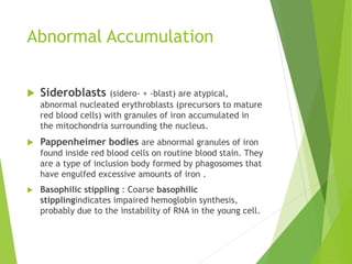 sideroblastic anemia | PPTX
