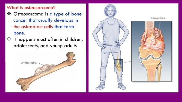Osteosarcoma.pdf