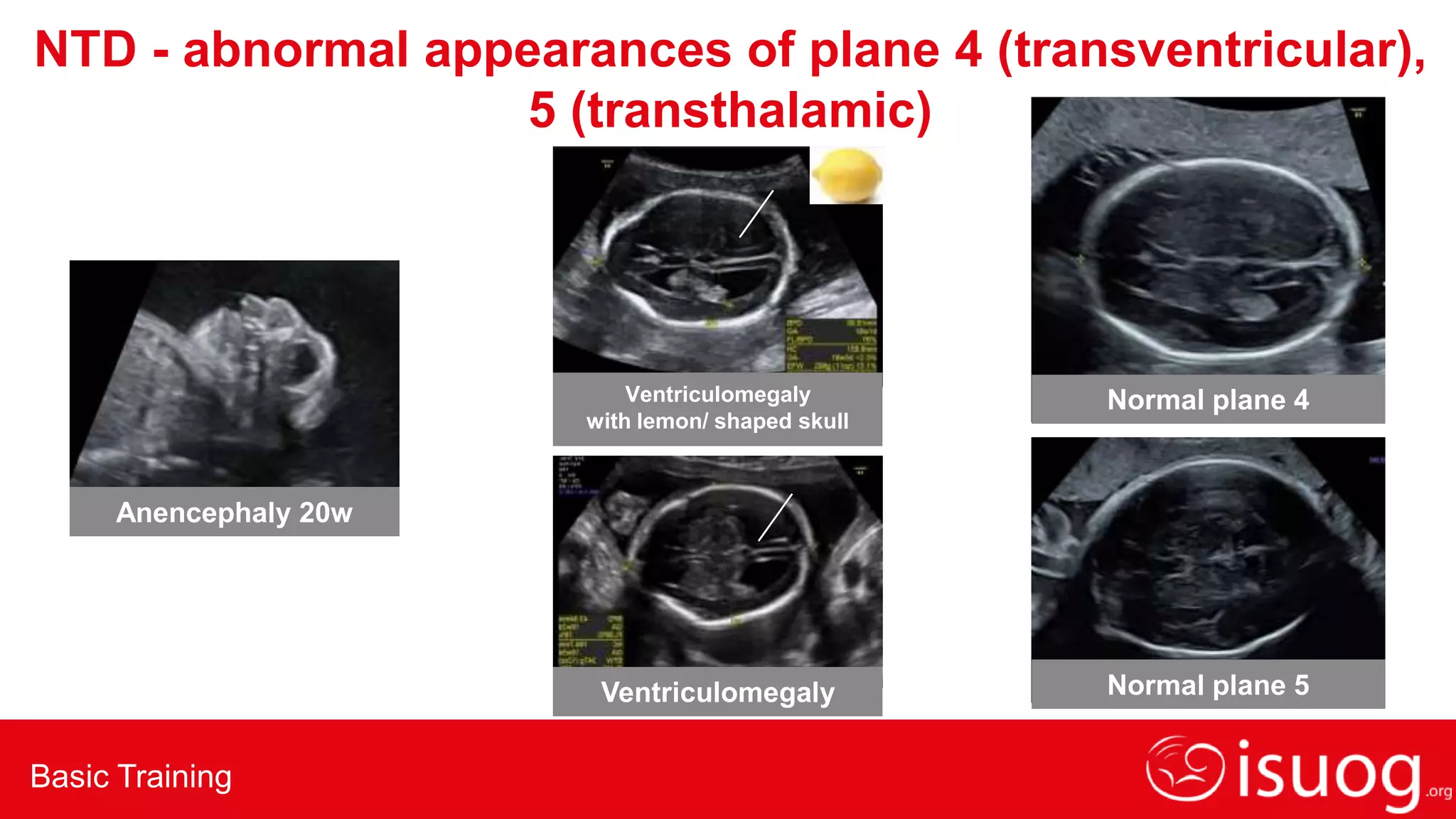 Lecture 12 distinguishing between normal and abnormal appearances of ...