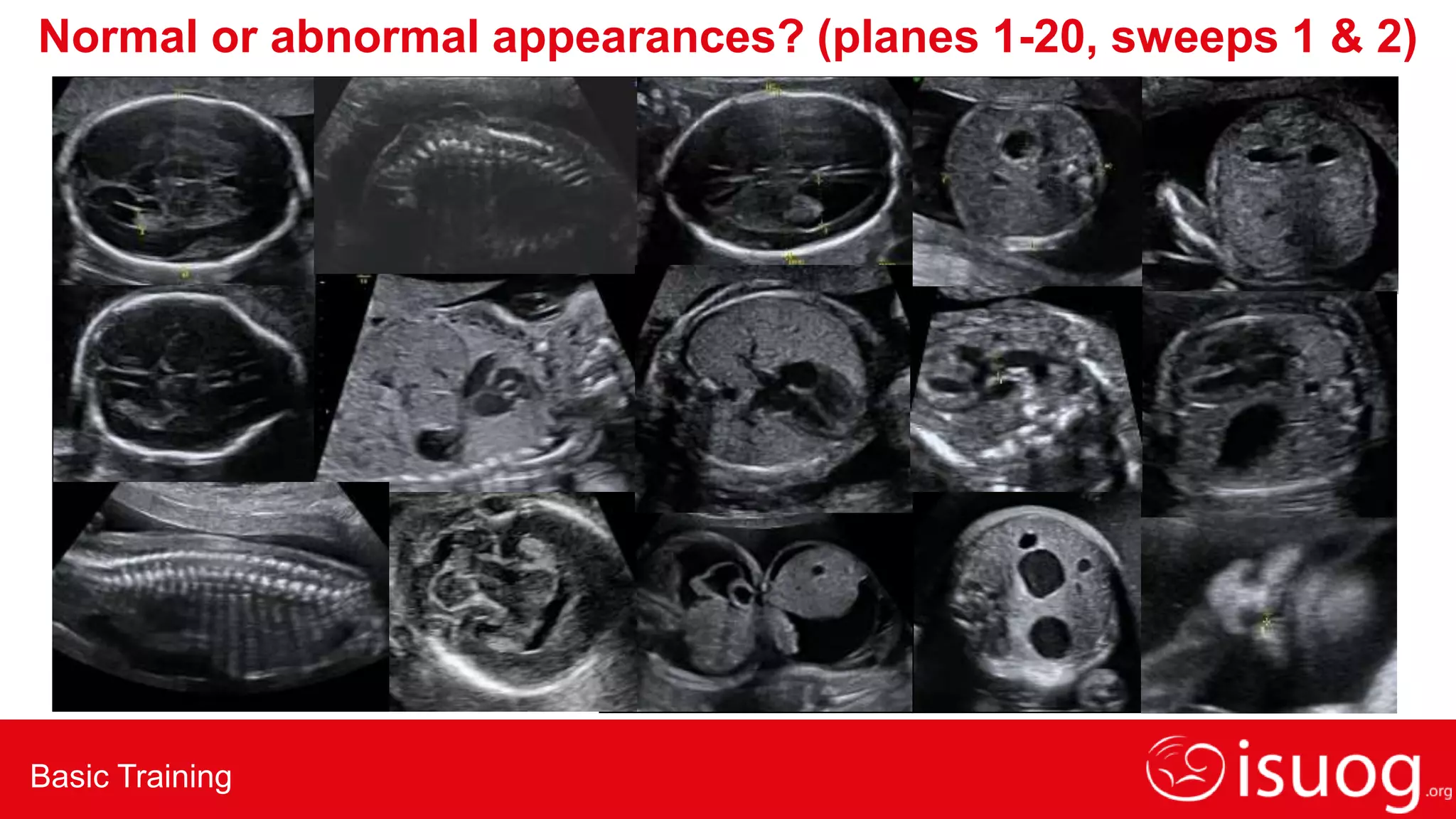 Lecture 12 distinguishing between normal and abnormal appearances of ...