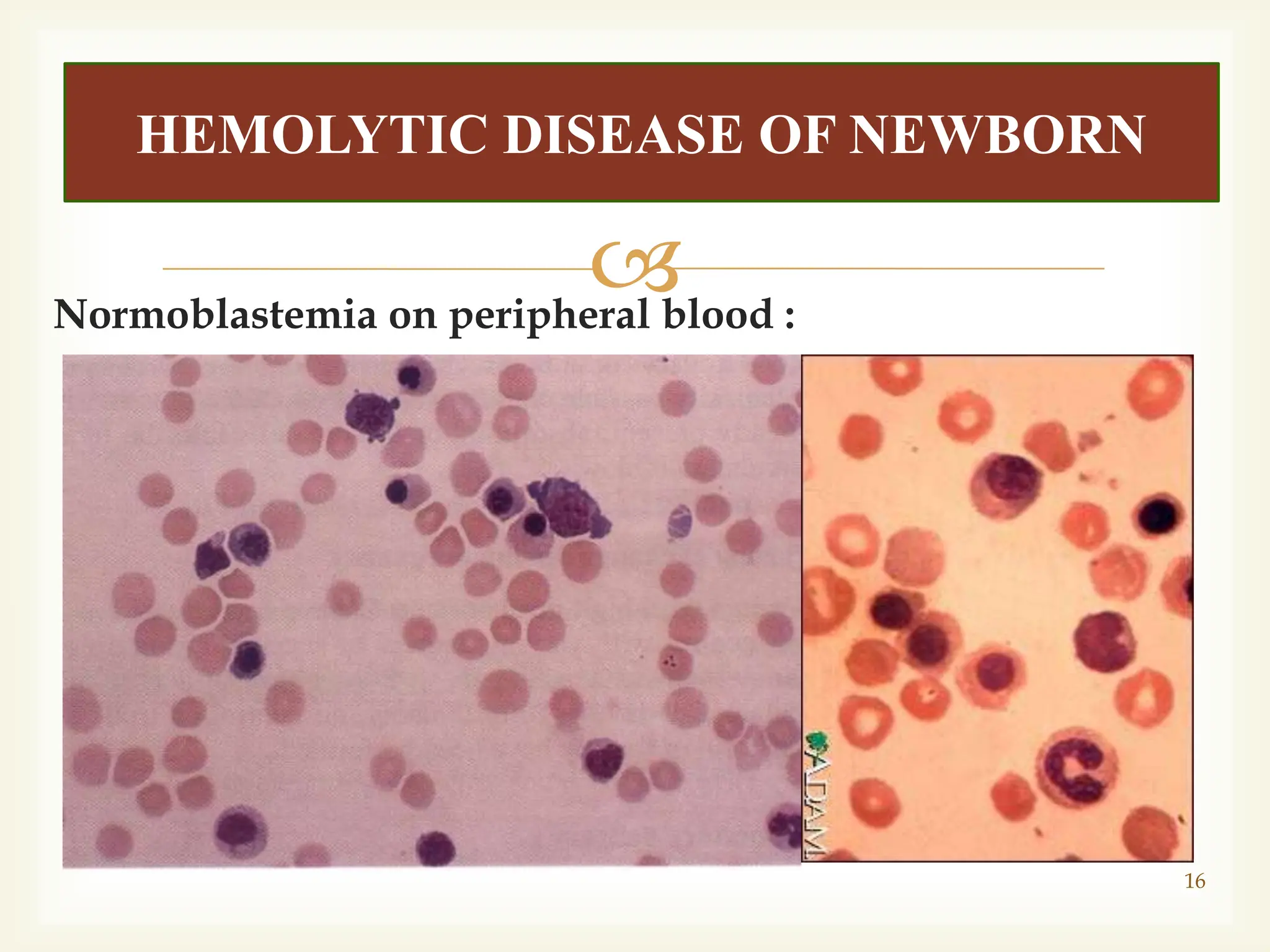 Hemolytic Disease of newborn .. In which Hemolysis if RBC Occurs | PPTX