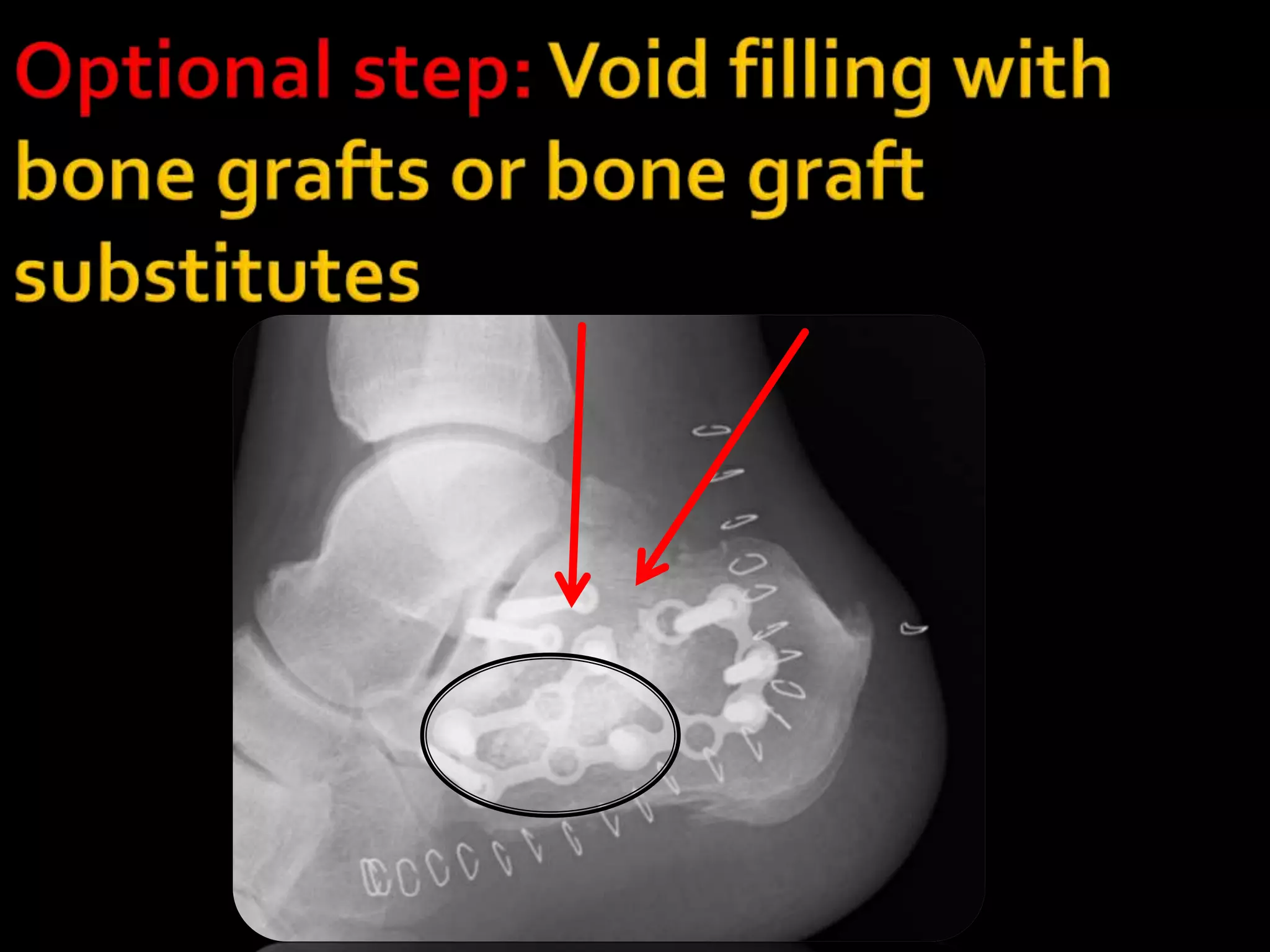 Lecture 12 shah orif calcaneal fractures | PPTX