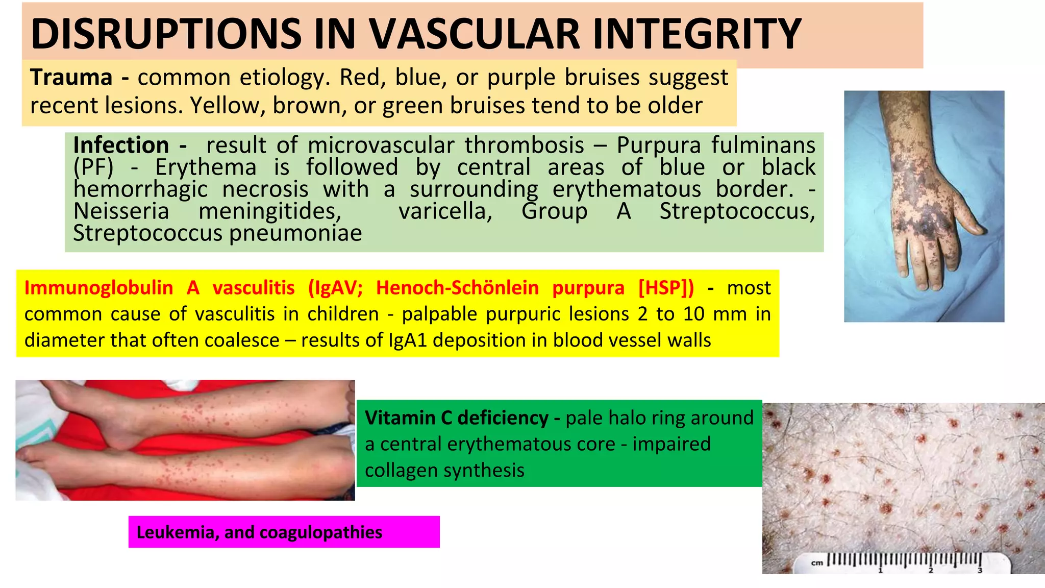 Lecture_13,14 Vasculitis and JIA.pptx
