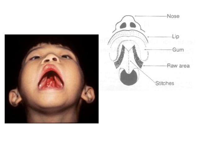 Lecture 13 face, nose palate 22042010 pdf | PDF