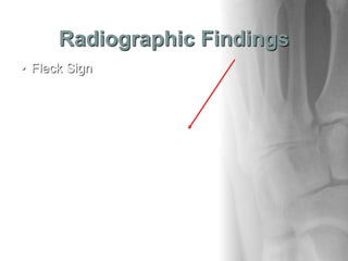 Lecture 15 parekh lisfranc | PPT