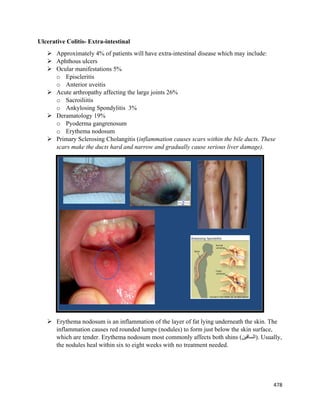 Lecture 17 Colon Disorders - Pathology | PDF