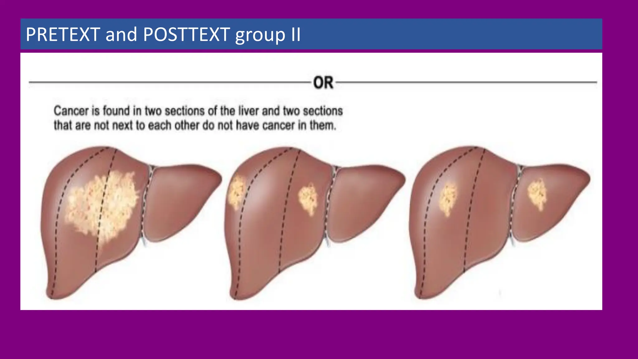 Hepatoblastoma-HB.pdf