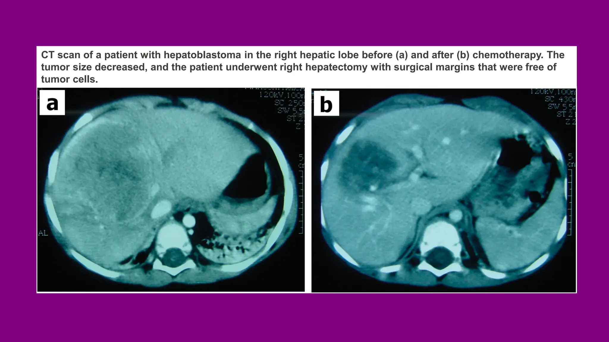 Hepatoblastoma-HB.pdf