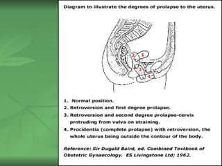 Lecture 19 - genital prolapse and management | PPT