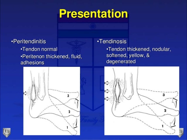 Lecture 19 parekh non insertional and insertional achilles tears