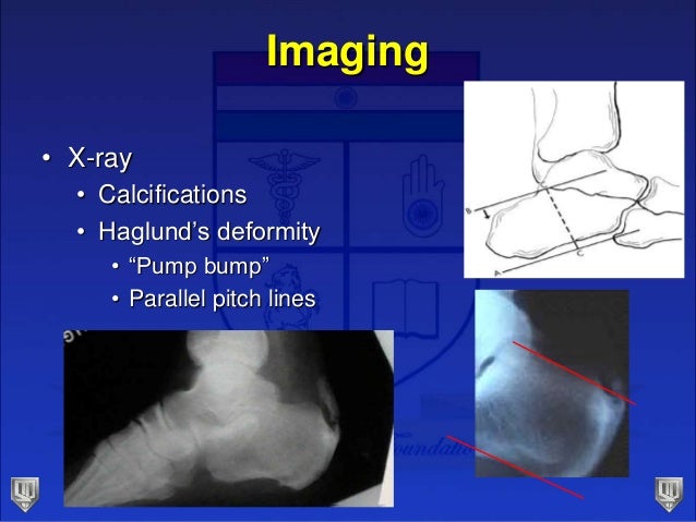 Lecture 19 parekh non insertional and insertional achilles tears