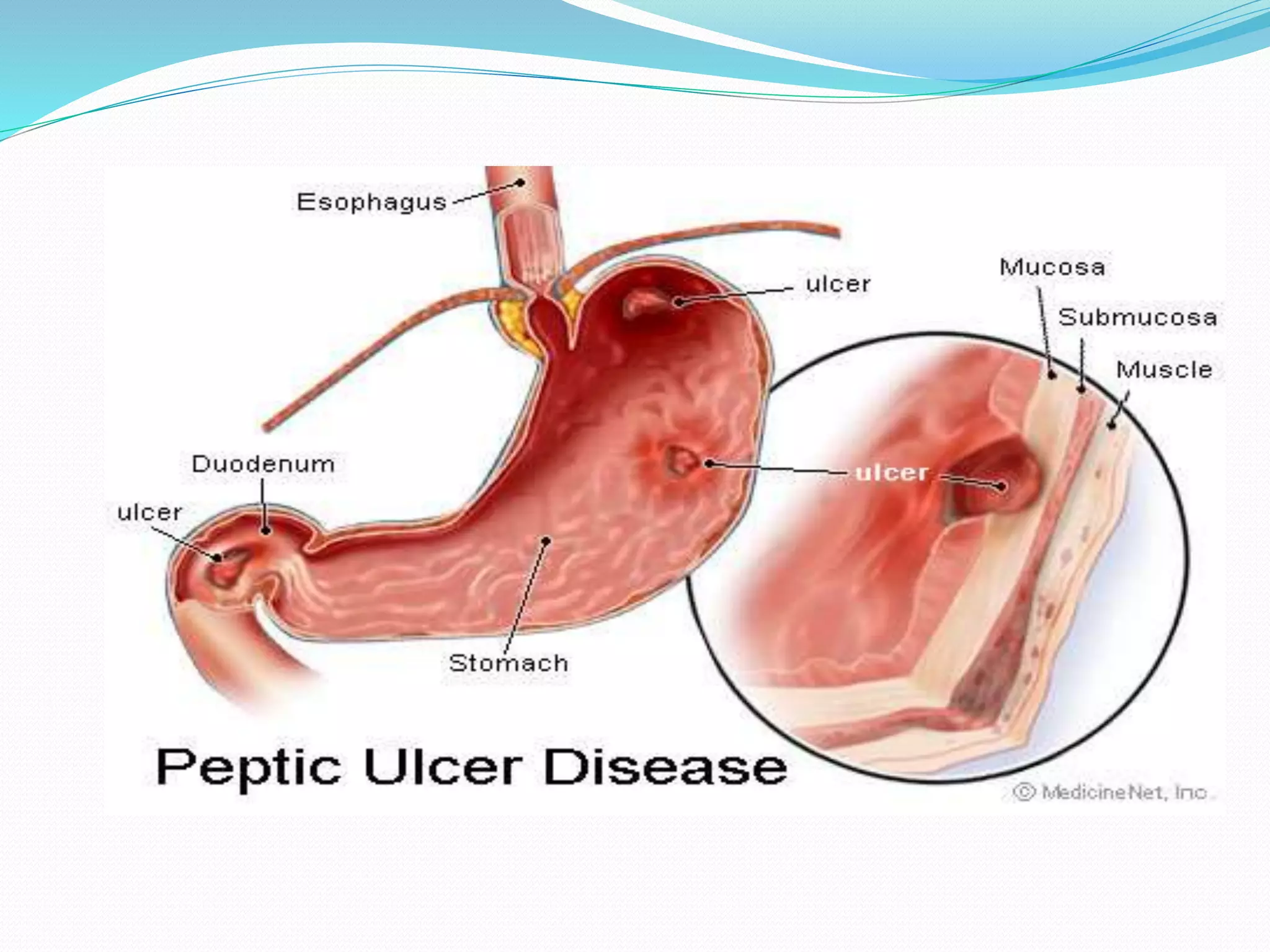 ( Peptic ulcer disease ) .pptx