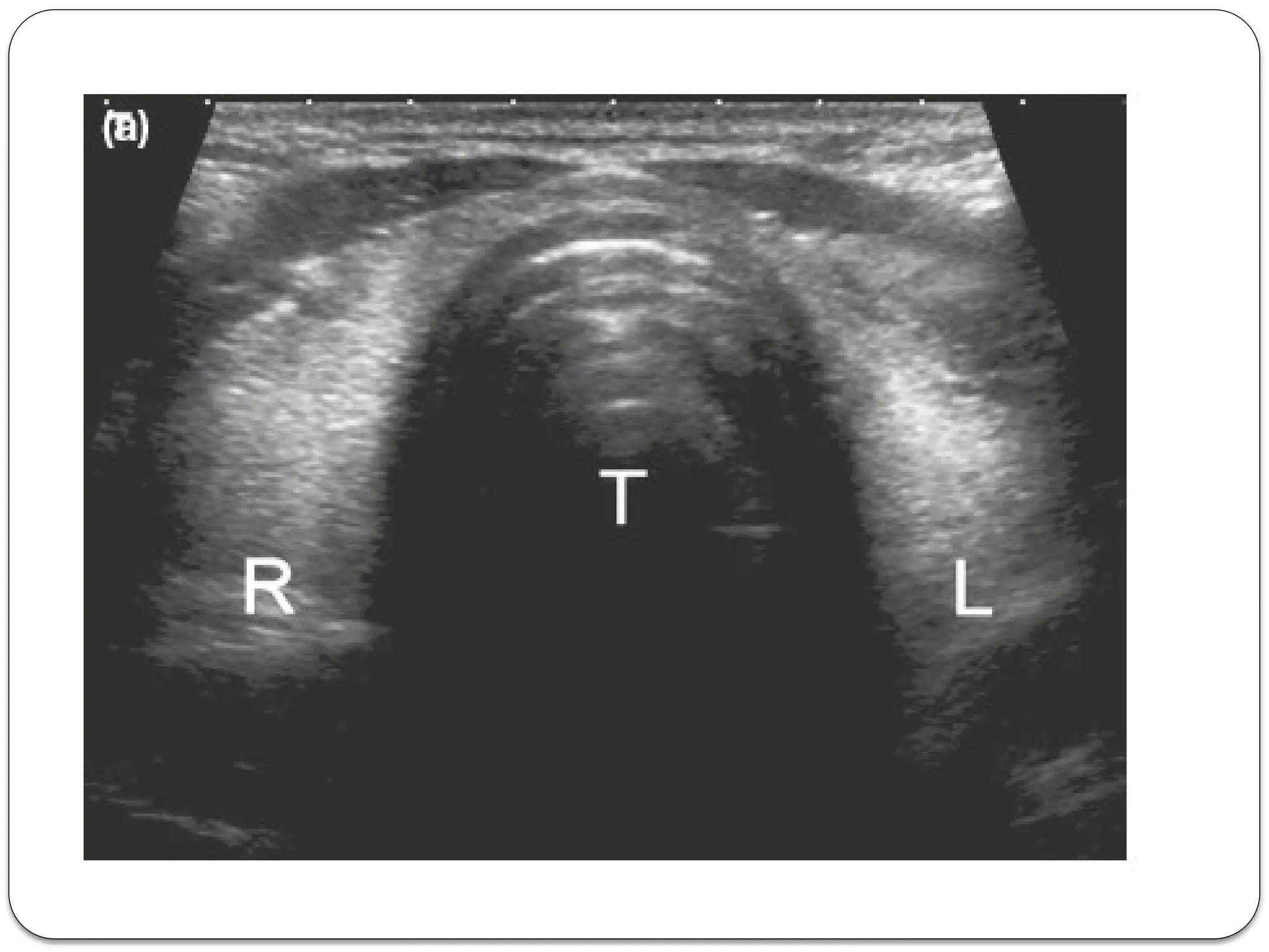 Lecture 1 Evaluation Of Thyroid Nodule Pptx
