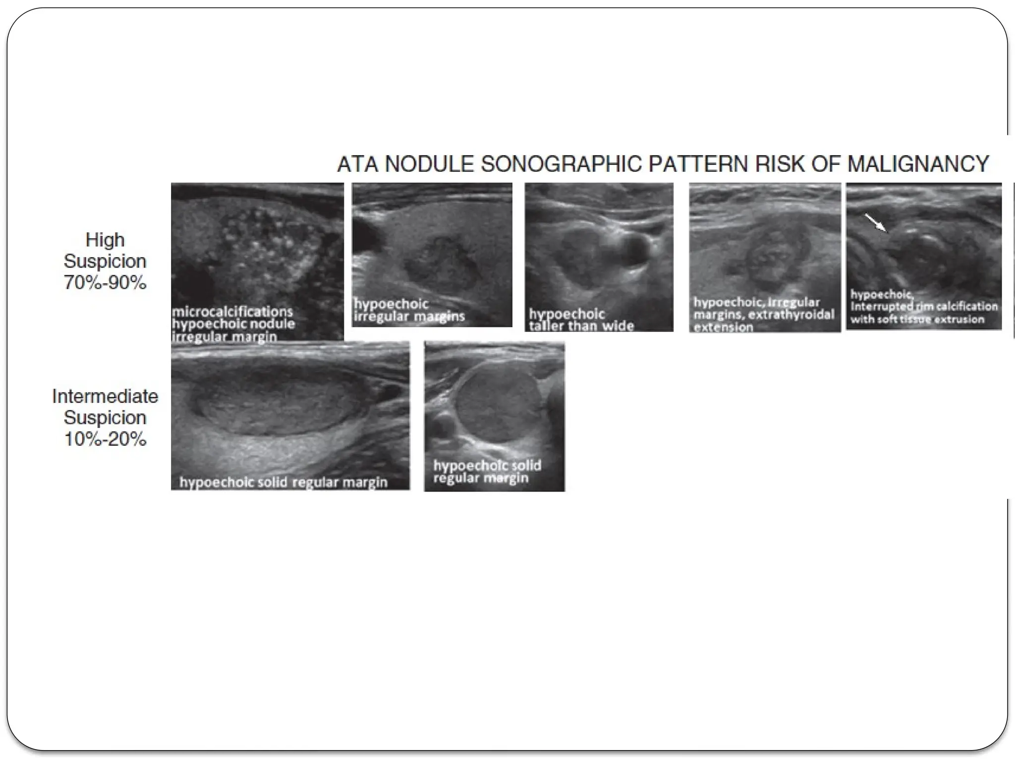Lecture 1 Evaluation Of Thyroid Nodule Pptx