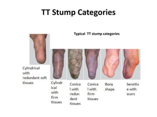 Lecture 1;TRANSTIBIA PROSTHETICS-1.ppt