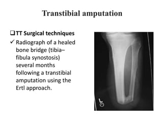 Lecture 1;TRANSTIBIA PROSTHETICS-1.ppt