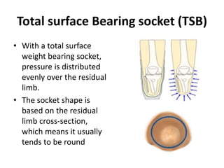 Total Surface Bearing Socket