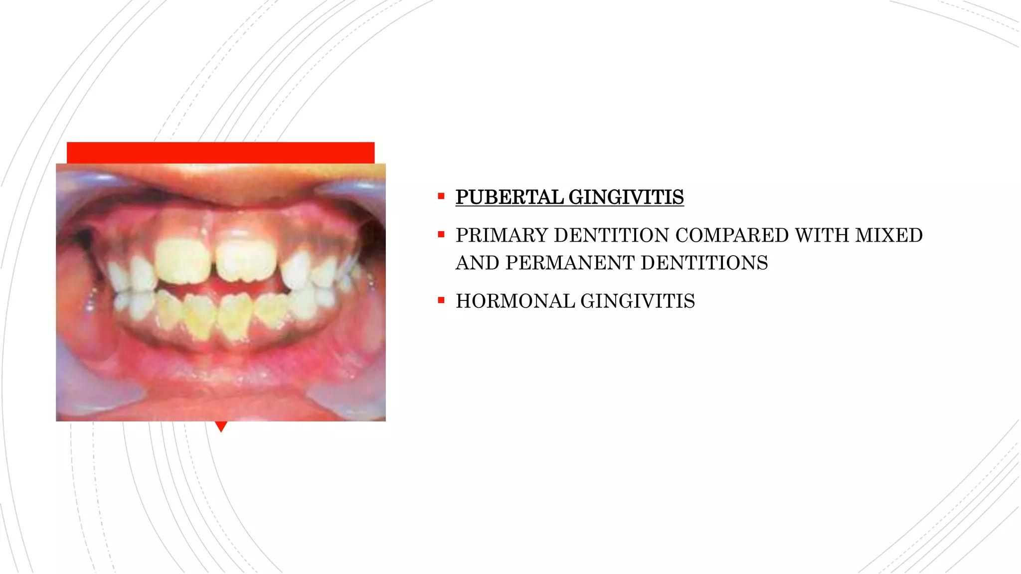 GINGIVA IN CHILDREN | PPTX
