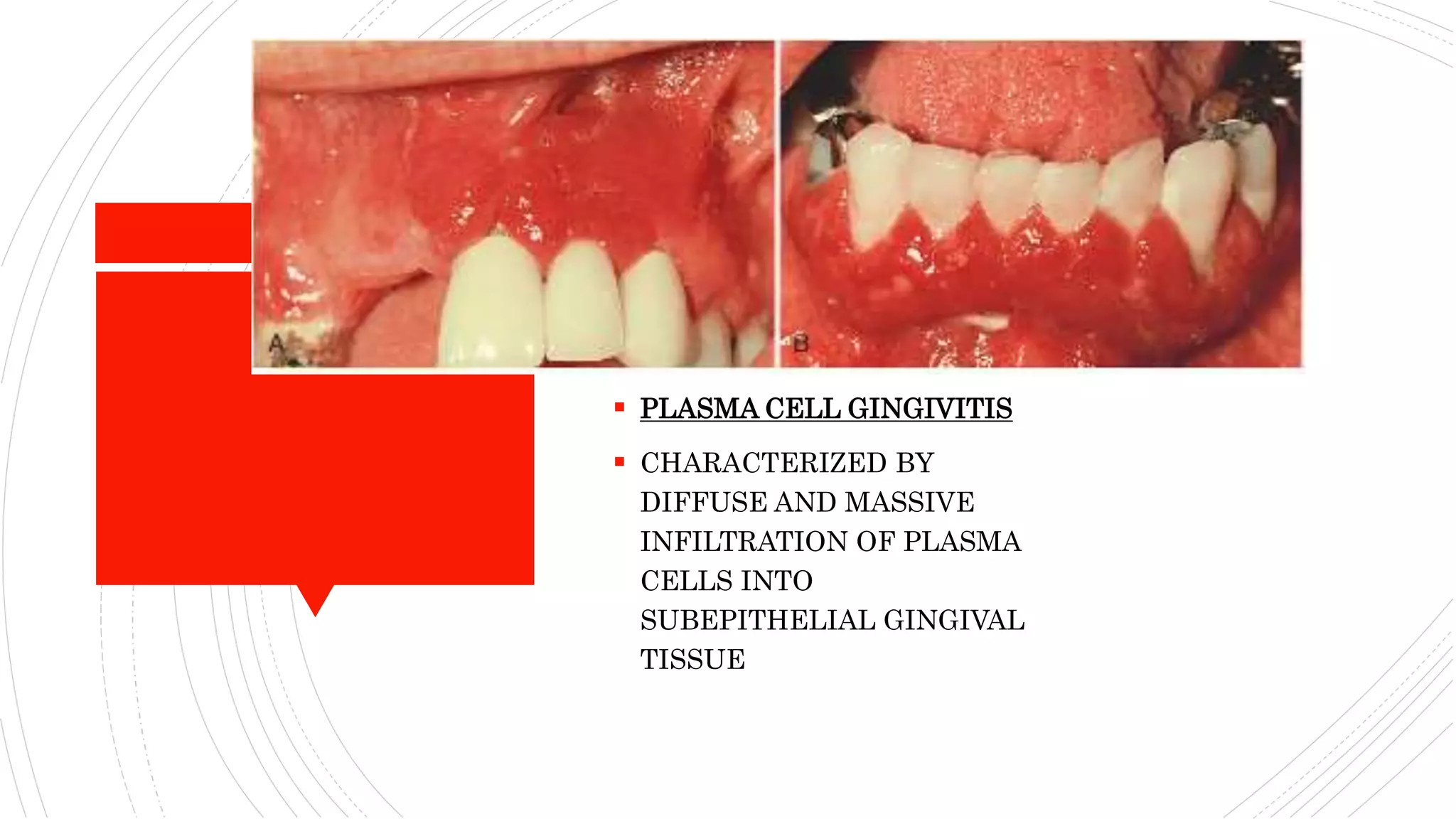 GINGIVA IN CHILDREN | PPTX