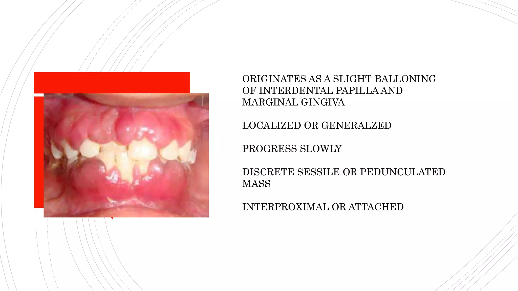 GINGIVA IN CHILDREN | PPTX
