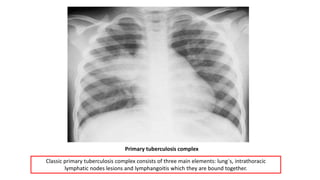 Lecture 2. Primary TB.pptx